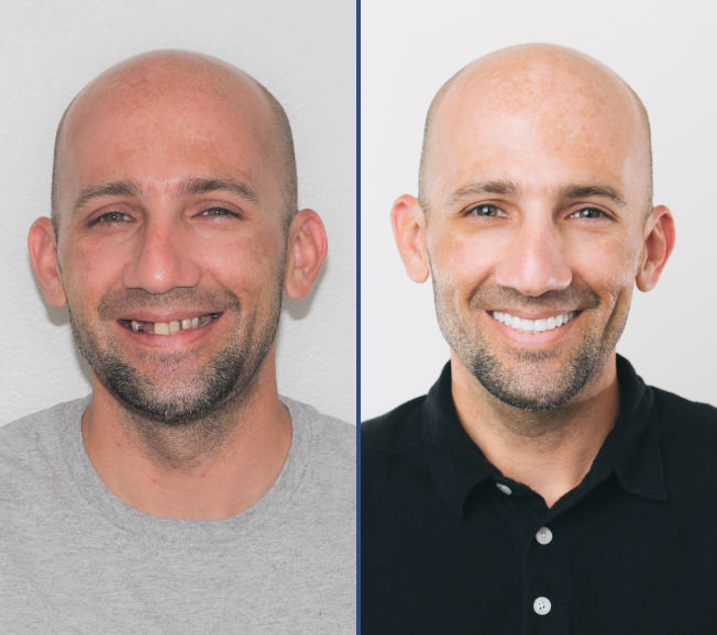 All-on-4 Dental Implants | Revive Dental Implant Center