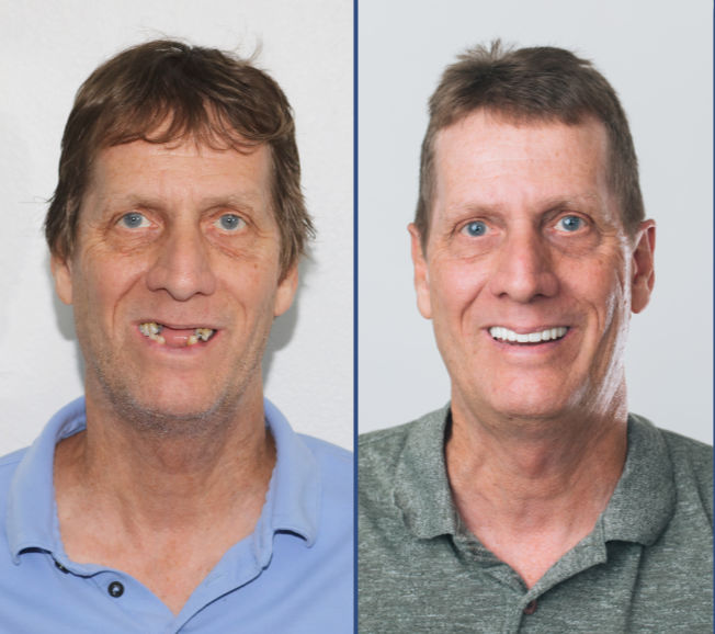 All-on-4 Dental Implants | Revive Dental Implant Center