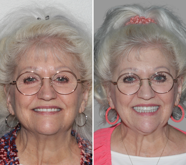 Revived Smiles | Revive Dental Implant Center