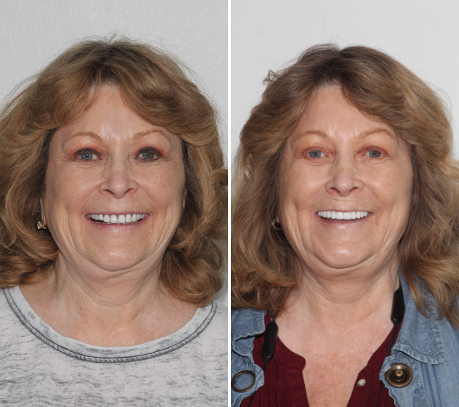 Revived Smiles | Revive Dental Implant Center