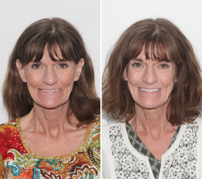 Revived Smiles | Revive Dental Implant Center