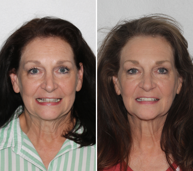 Revived Smiles | Revive Dental Implant Center
